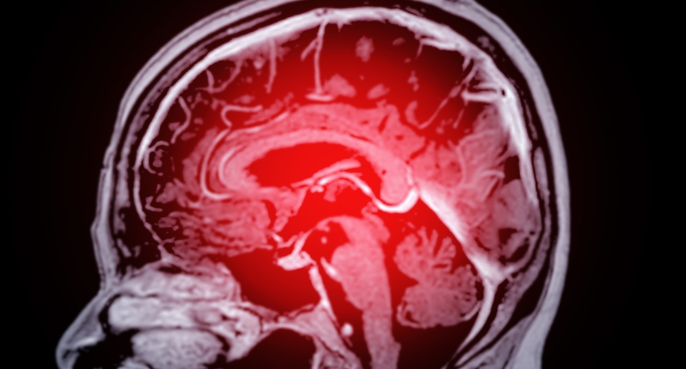 Warning signs of stroke your body might be sending