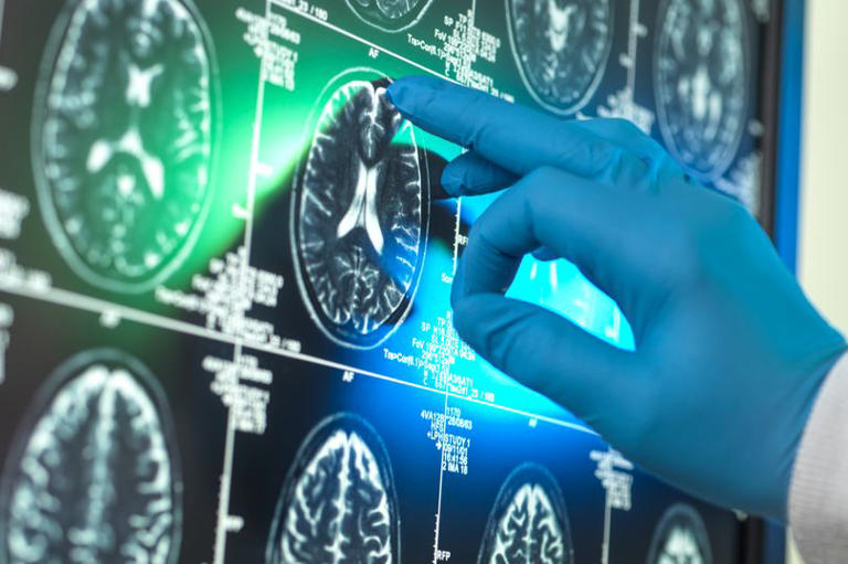 Drug taken by millions found to increase dementia risk by 33 per cent