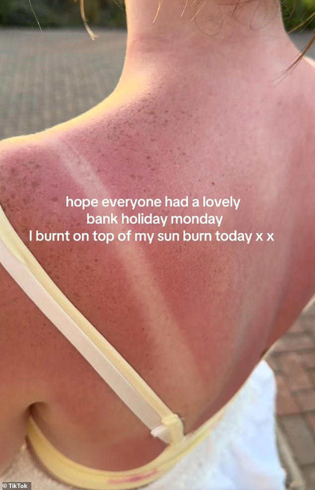 Should have remembered their SPF! Baked Britons show off their painful ...