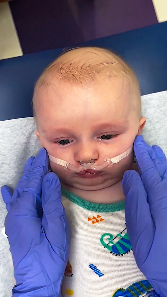 Lip repair for newborns