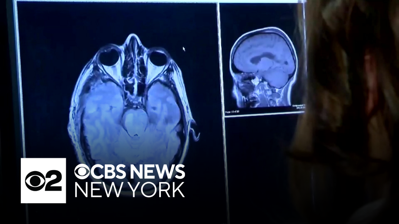 Blood test may soon be able to detect and stage Alzheimer's disease