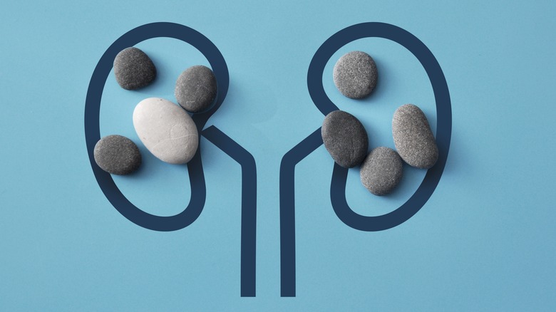 Foods that could cause kidney stones
