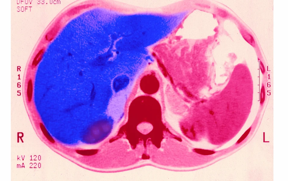 Monthly binge drinking tied to higher liver scarring risk in MASLD