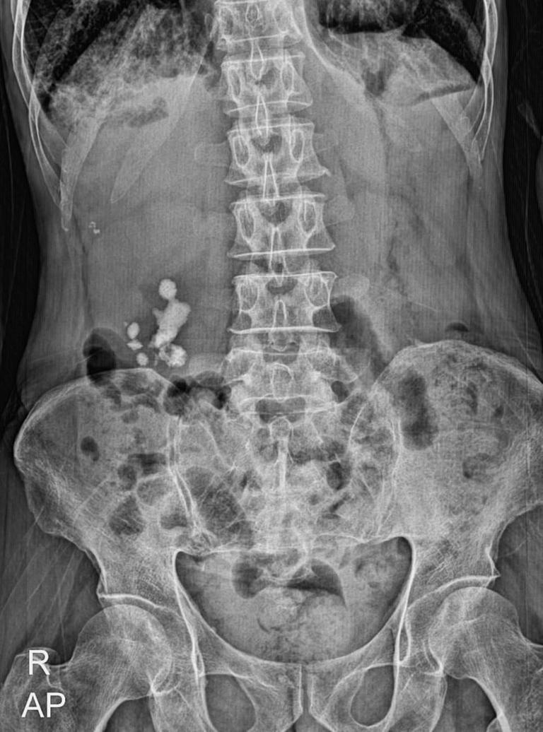 Chinese man who suffered painful urination for 3 years discovers 1.3kg ...