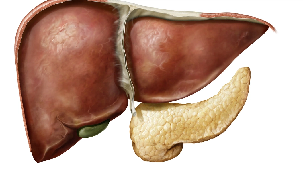 Monthly binge drinking tied to higher liver scarring risk in MASLD