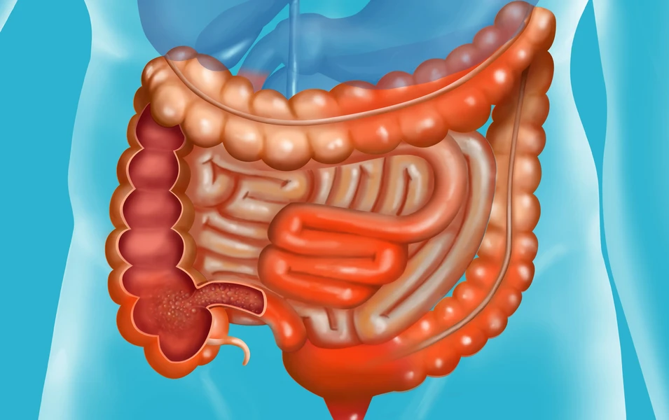 New research clarifies key differences between Crohn’s and colitis