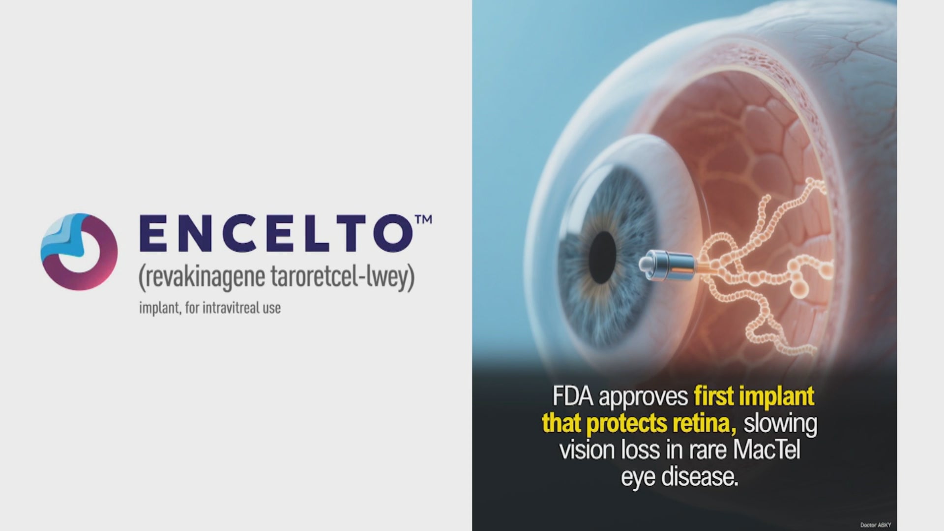 Medical breakthrough: FDA-approved implant slows vision loss in MacTel ...