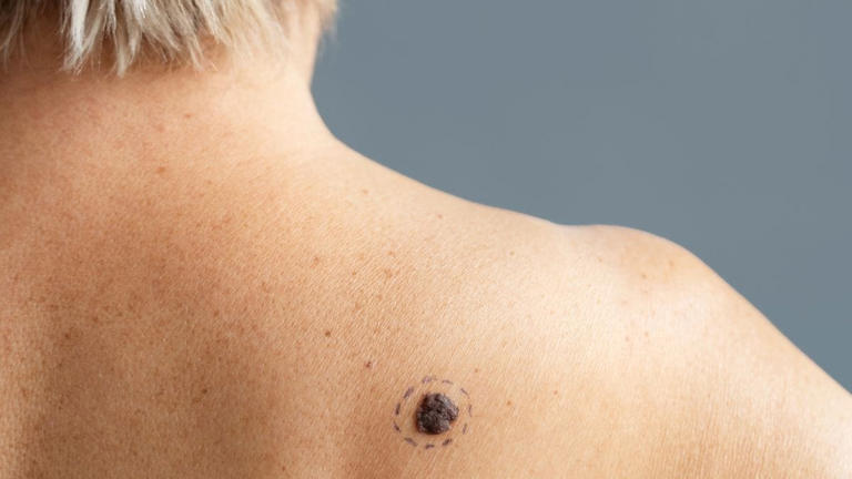 How to stop skin cancer in time? Smart tattoo is science’s latest ...