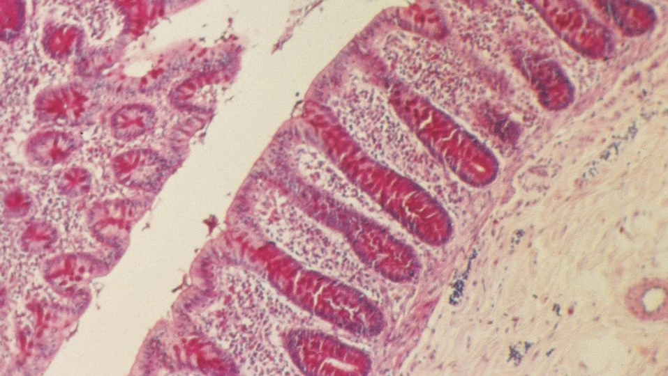 New research clarifies key differences between Crohn’s and colitis