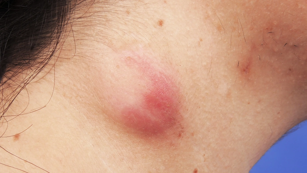 Understanding and caring for benign skin growths