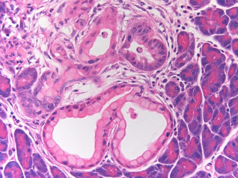 'Game changer' experimental drug doubles survival time for pancreatic ...