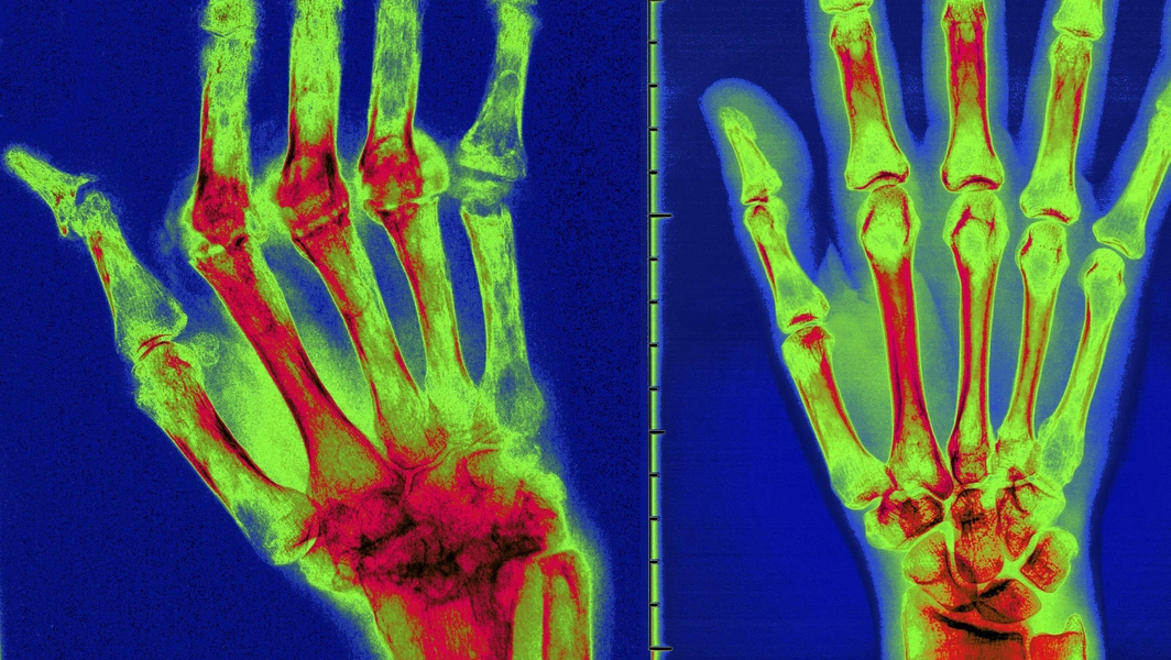 23 natural remedies for rheumatoid arthritis