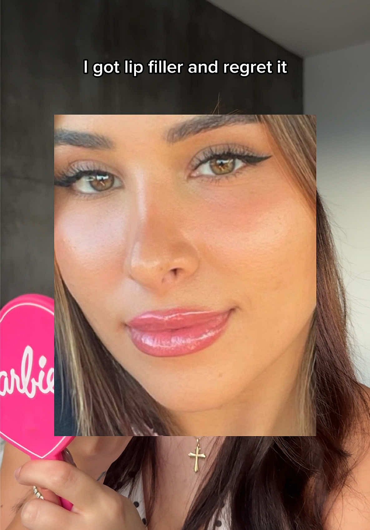 Why I regret getting lip filler: my honest experience
