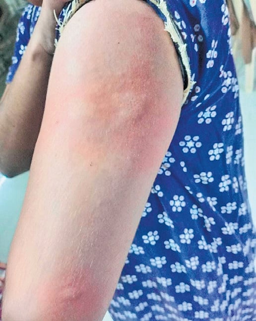Victoria bedbug nightmare: Management claims issue resolved