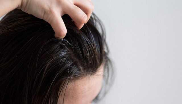8 home remedies to treat dandruff in summer