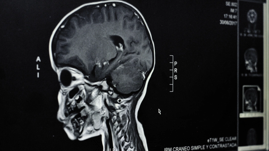 Brain age gap in children linked to later coping habits