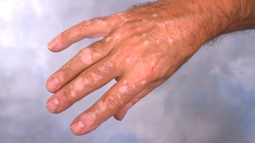 21 rare genetic traits and conditions