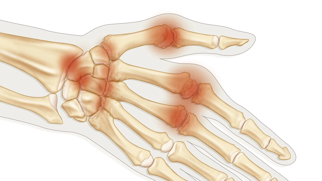 23 natural remedies for rheumatoid arthritis
