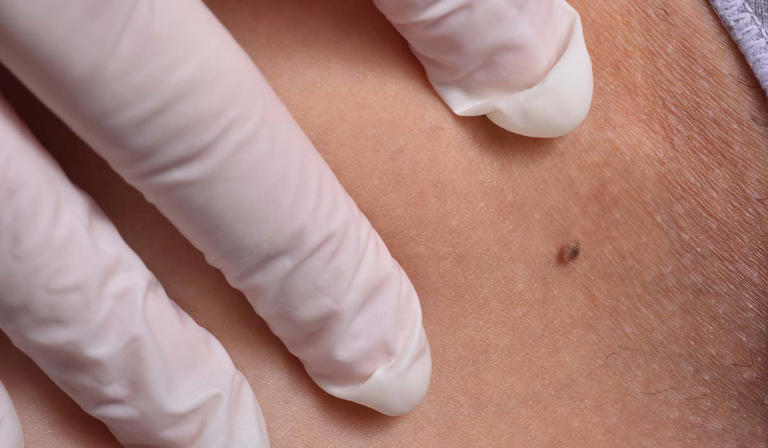 Skin cancer patients could soon benefit from revolutionary risk ...