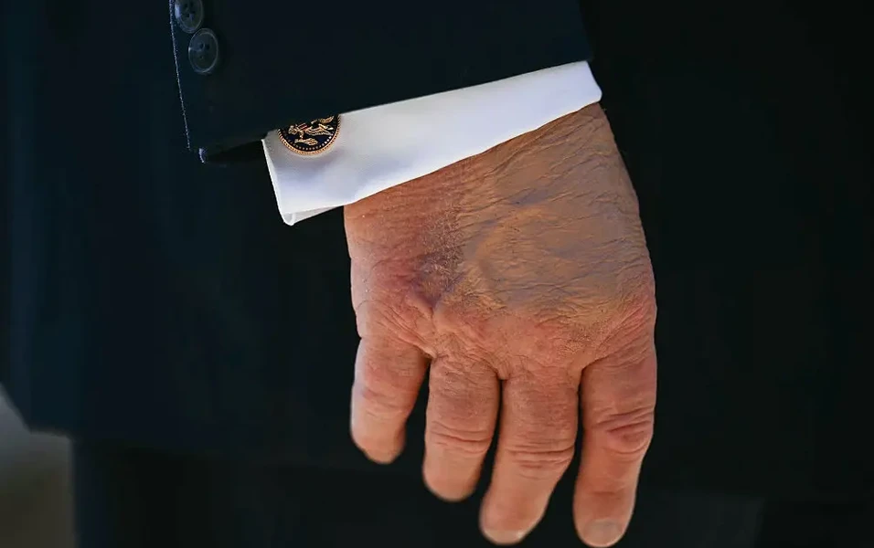 White House cites handshaking, aspirin for Trump's bruises