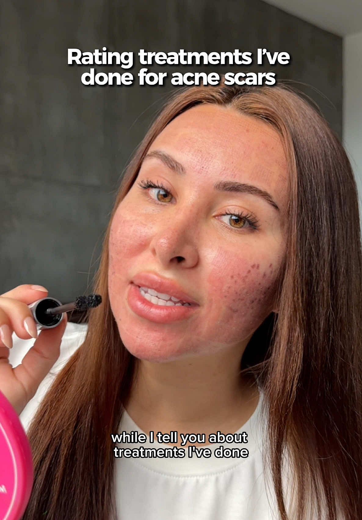 Best professional treatments for acne scars that actually work