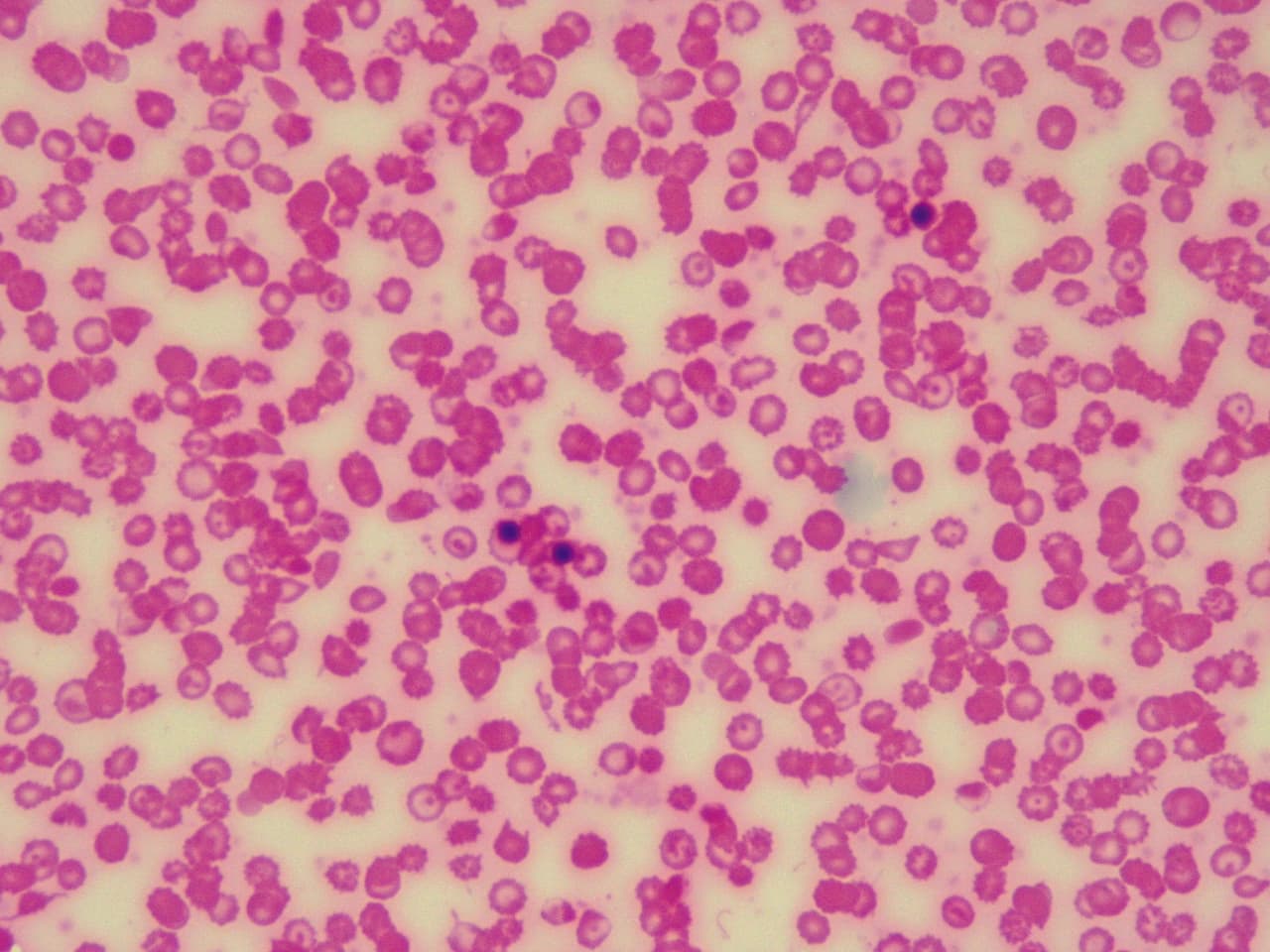 This biotech stock plunges 52%. Its sickle cell drug has 'no viable ...