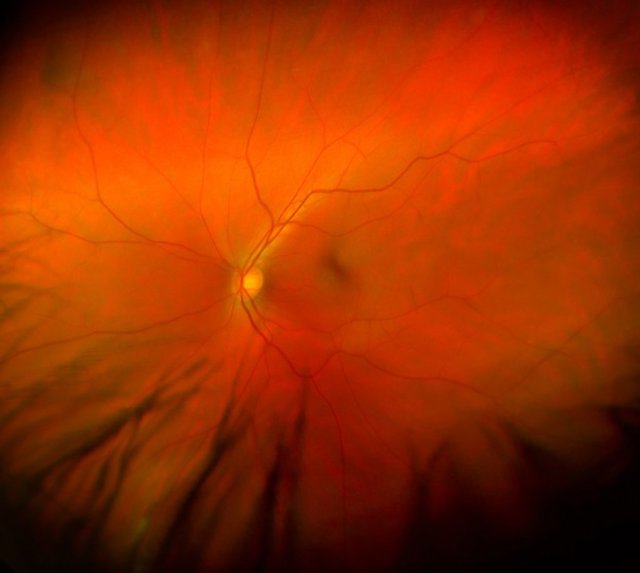 Oftalmólogo advierte de que el edema macular diabético puede causar una ...