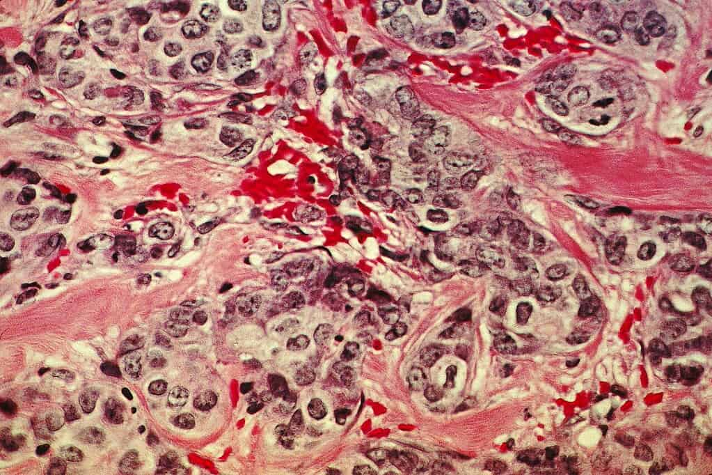 Smaller cancer cells may be more dangerous than we thought