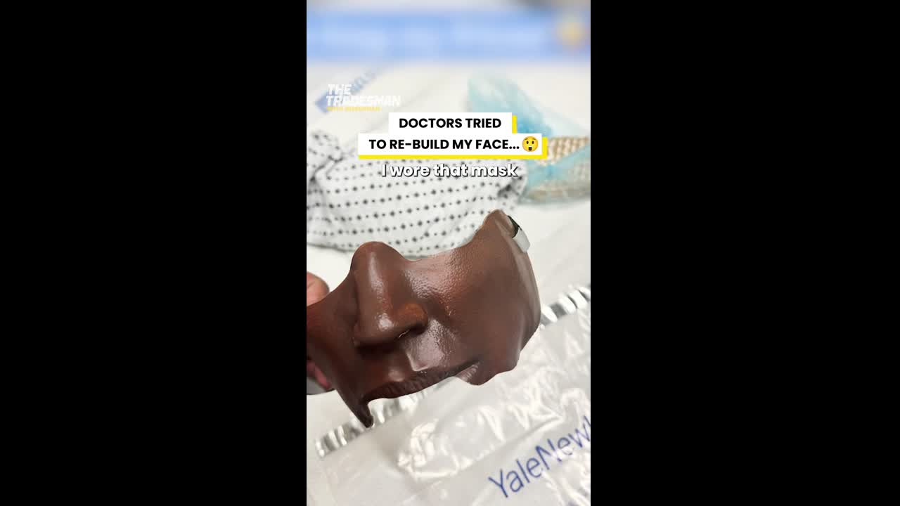Doctors tried to re-build my face