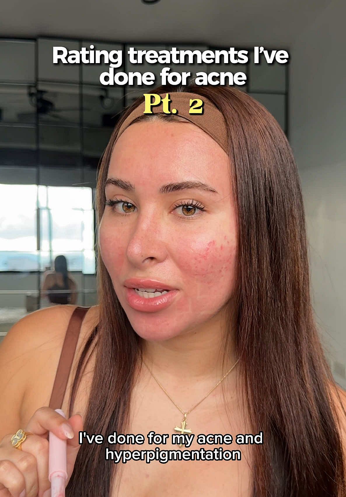 The acne scar treatment worth saving for your next appointment