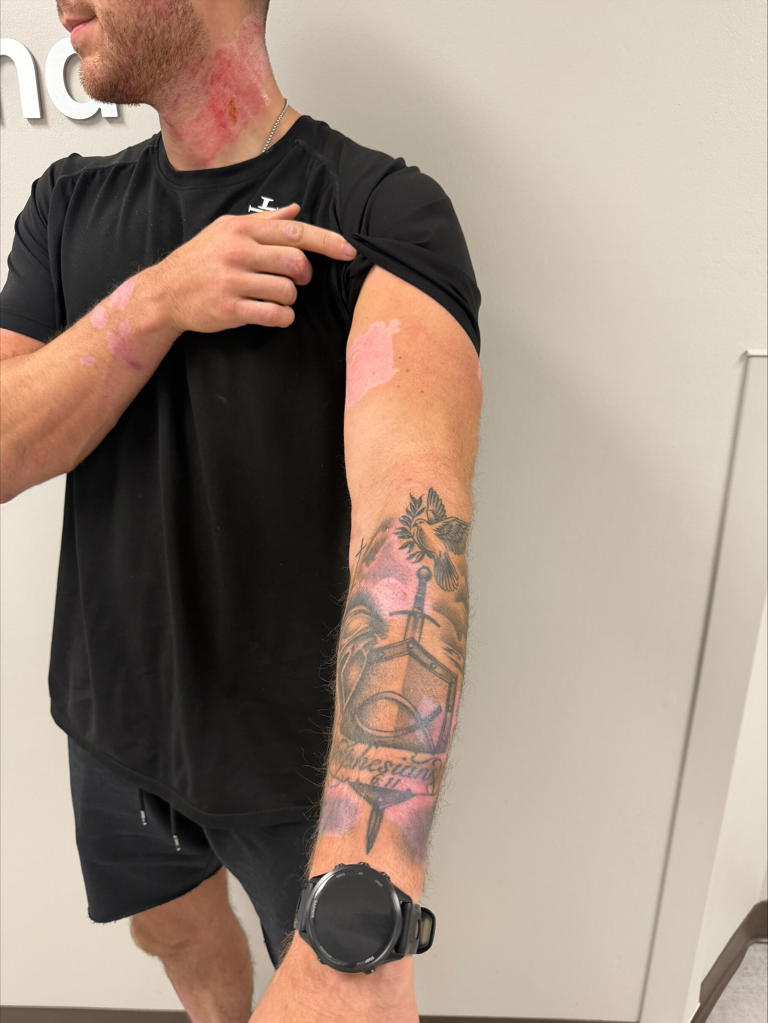 Glasgow firefighter recovers from burn injuries sustained in house fire