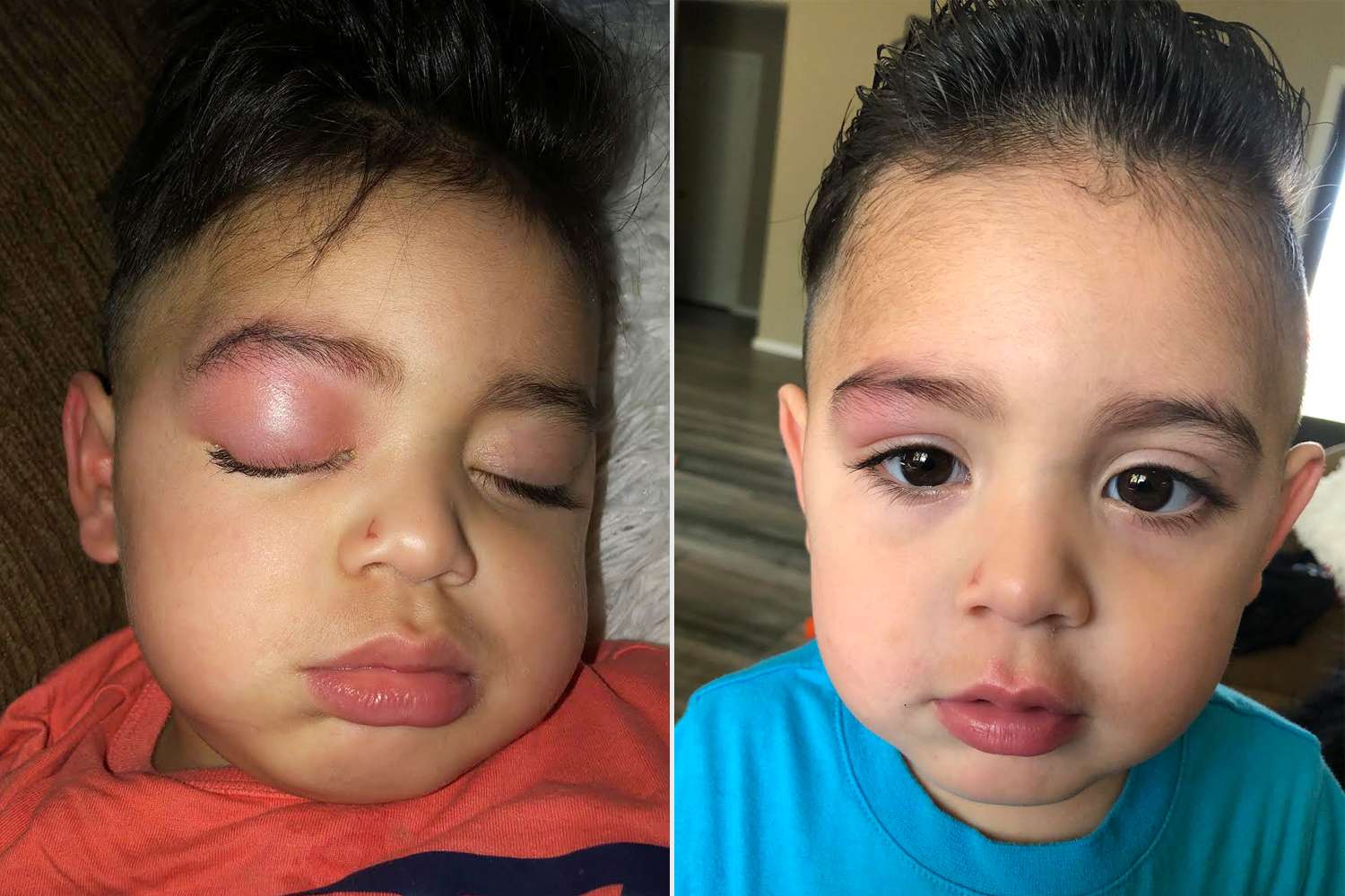 Mom thought her son’s mosquito bite was harmless. By morning, his eye ...