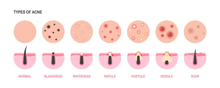 How to beat adult acne at every age