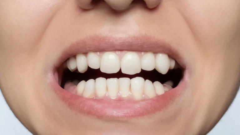 Long-term side effects of tooth extraction: Here is what a dentist ...
