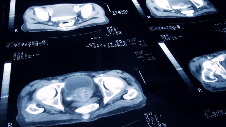 'Missed opportunity' as government rejects call for mass prostate ...