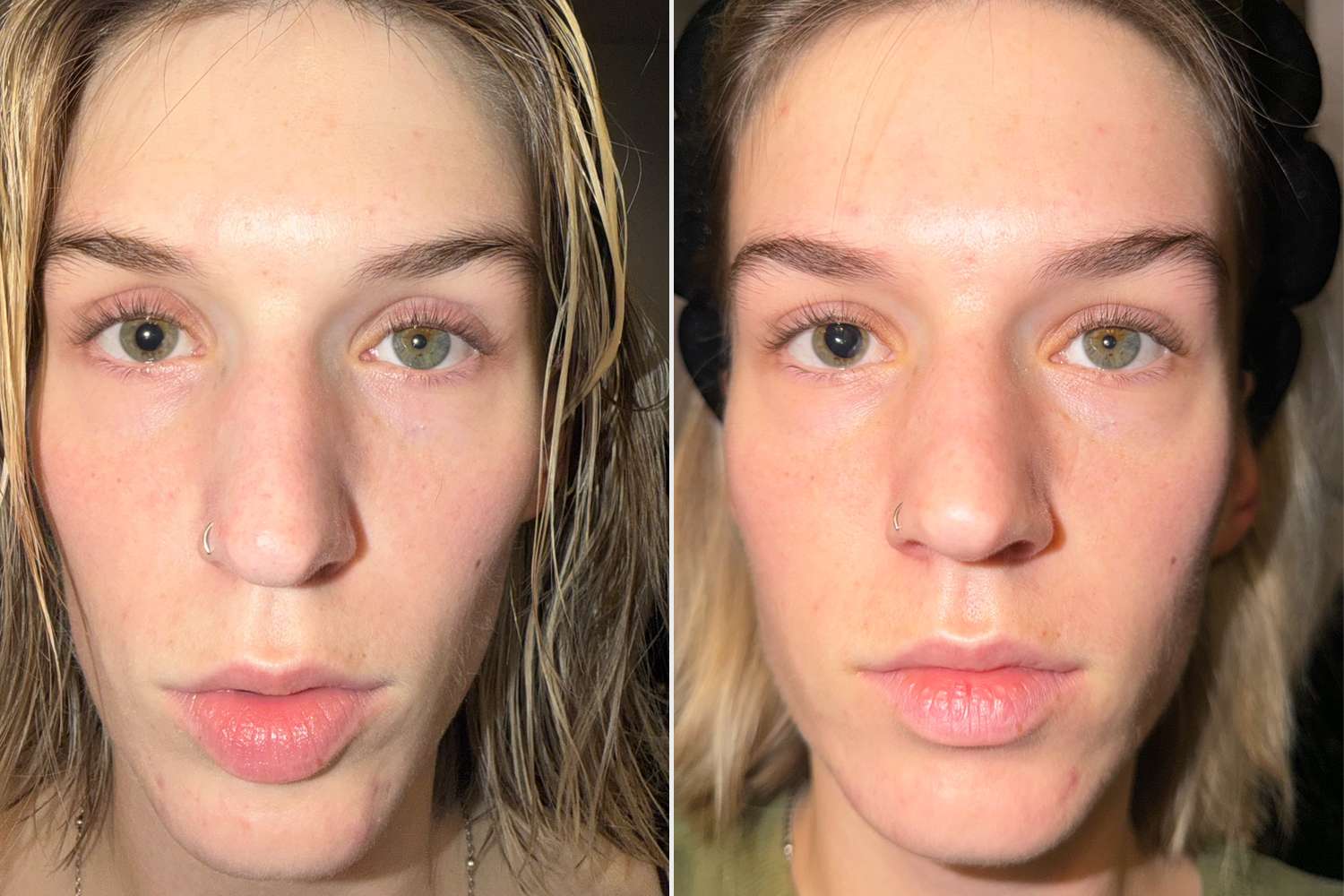 Woman deals with permanent damage after being hit in the eye with a ...