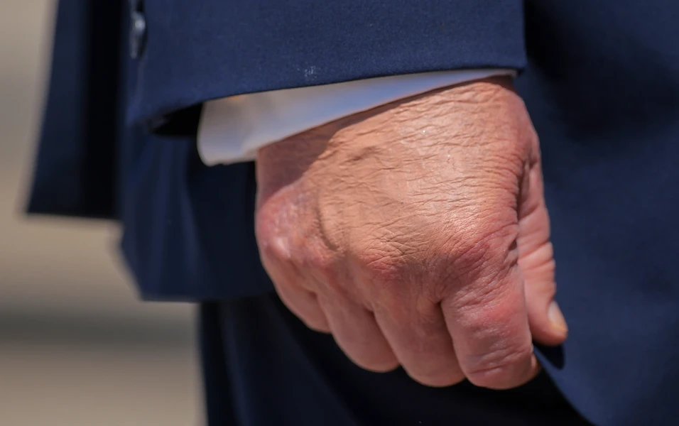 Trump doctor cites aspirin, handshakes for bruised hands