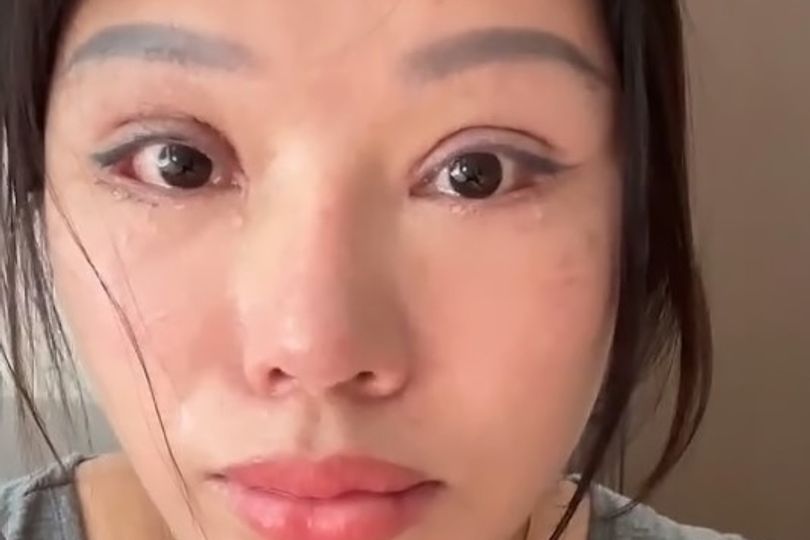 Woman forced to sleep with eyes open after plastic surgery goes ...
