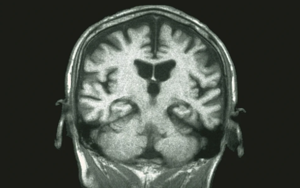Finnish brain scans dispute long COVID inflammation theory