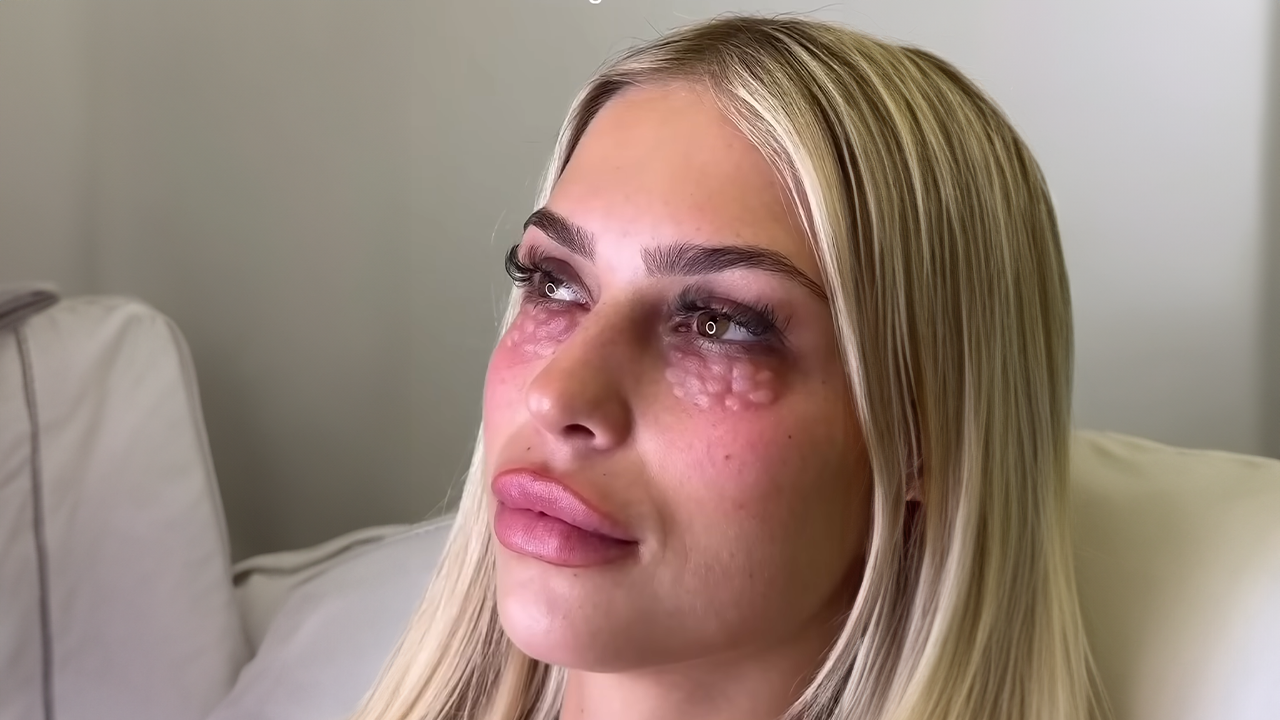 Doctor explains how to treat under-eye dark circles