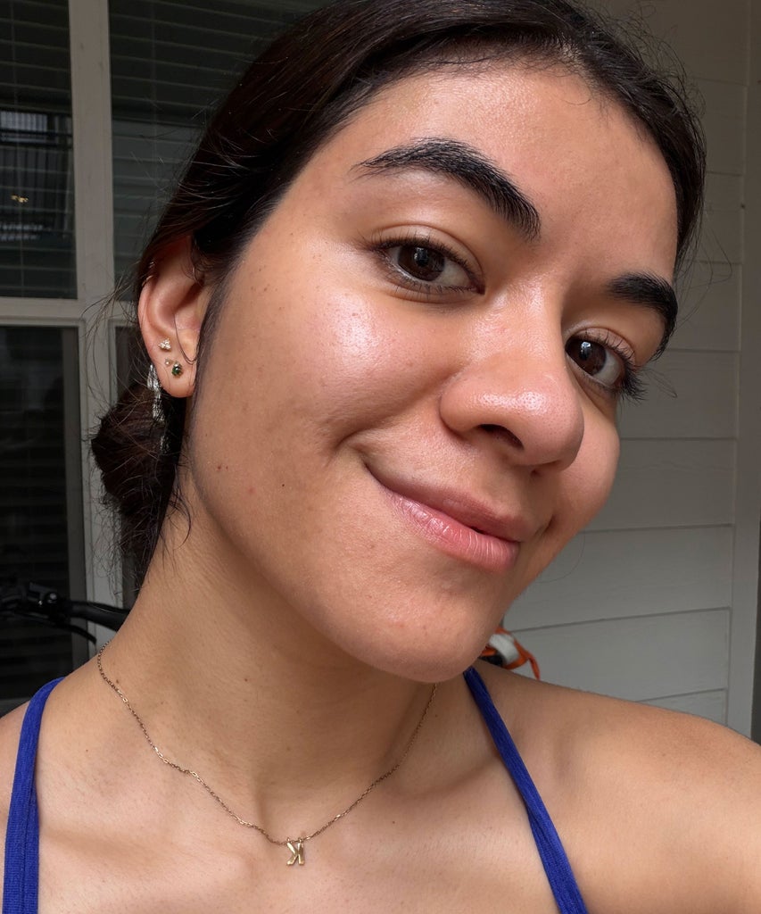 I thought my hyperpigmentation was acne scarring — until a ...