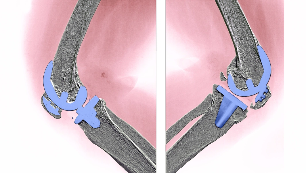 16 exercises to avoid after knee replacement