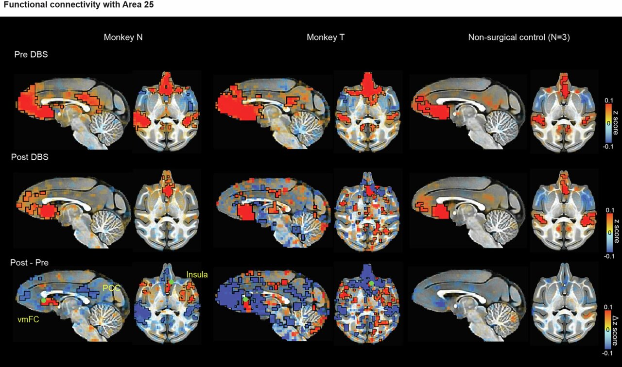 Deep brain stimulation boosts myelination and shifts brain networks ...