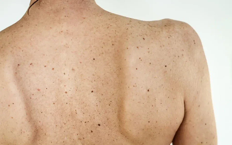 Beauty editor learns dark spots were benign DPN