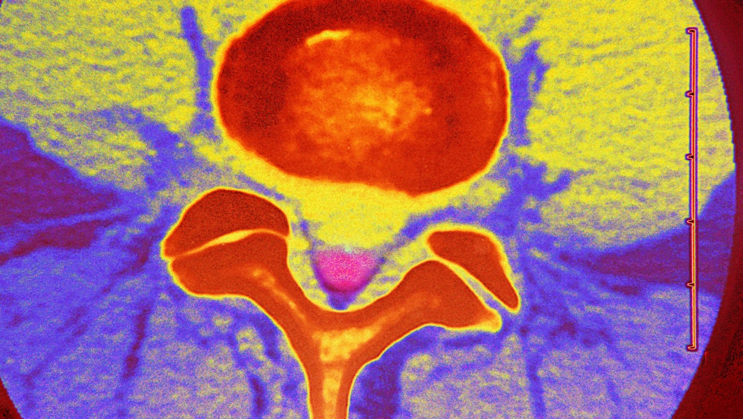 Experts outline key differences between sciatica and SI joint pain