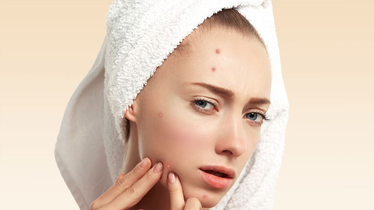 Can severe dandruff cause pimples on face? Dermatologist explains