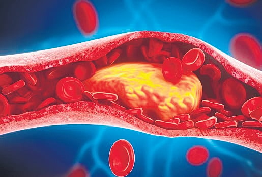 Kerala doctors successfully filter out deadly bad cholesterol from ...