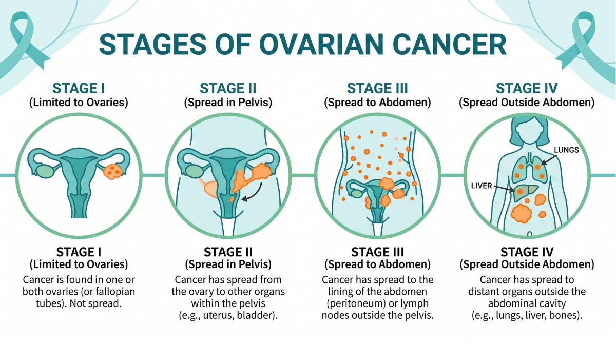 Stages of ovarian cancer: What every woman should know