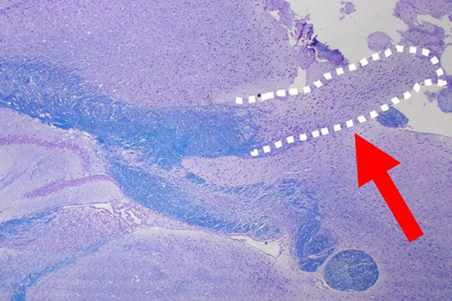 Promising anti-aging drug may cause brain damage, scientists warn