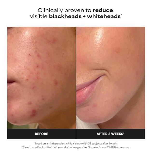 This bestselling exfoliant 'completely transformed my 51-year-old skin ...